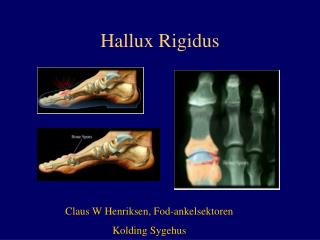 PPT - HALLUX RIGIDUS PowerPoint Presentation - ID:4912073