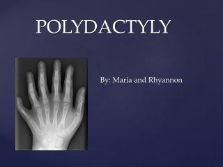 PPT - Polydactyly PowerPoint Presentation - ID:914900