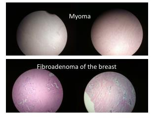 Subserous myoma PowerPoint (PPT) Presentations, Subserous myoma PPTs ...