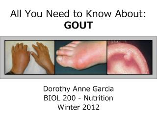 PPT - All You Need to Know About: GOUT PowerPoint Presentation, free ...