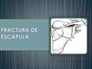 PPT - FRACTURA DE ESCÁPULA PowerPoint Presentation, free download - ID ...