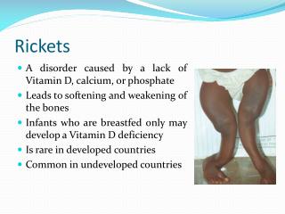 PPT - Rickets Disease PowerPoint Presentation - ID:2568458