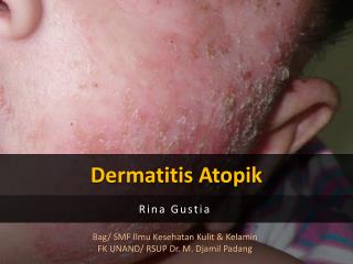 PPT - Dermatitis Atopik PowerPoint Presentation, free download - ID:2776980