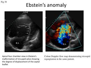 PPT - EBSTEIN'S ANOMALY OF TRICUSPID VALVE PowerPoint Presentation - ID ...