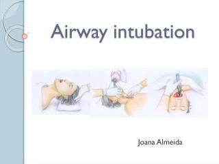 Awake intubation airway PowerPoint (PPT) Presentations, Awake ...