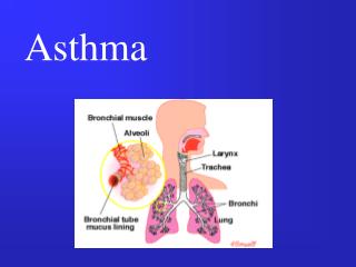 PPT - Asthma PowerPoint Presentation, free download - ID:2991929