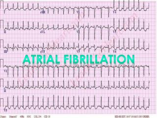PPT - ATRIAL FIBRILLATION PowerPoint Presentation, free download - ID ...