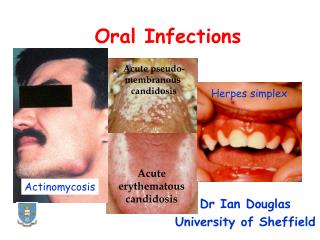 Oral yeast infections thrush PowerPoint (PPT) Presentations, Oral yeast ...