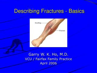 PPT - Describing Fractures - Basics PowerPoint Presentation, free ...