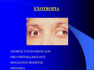 PPT - EXOTROPIA PowerPoint Presentation, free download - ID:3414230