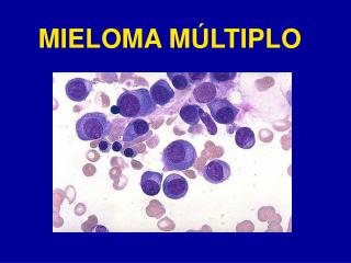 PPT - Mieloma Múltiple PowerPoint Presentation - ID:2178146