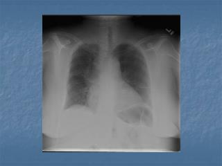 PPT - Clivus Bone Metastasis: Review of Cranial Nerves PowerPoint ...