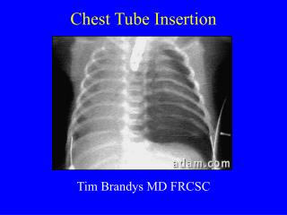 PPT - Chest Tubes PowerPoint Presentation - ID:259176