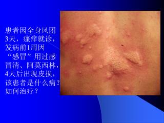 PPT - The urticaria control test (UCT) PowerPoint Presentation - ID:2318640