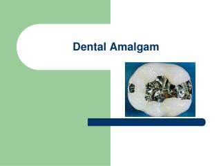 PPT - Bonded amalgam PowerPoint Presentation - ID:2981490