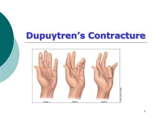 PPT - Dupuytren’s contracture PowerPoint Presentation - ID:2379372
